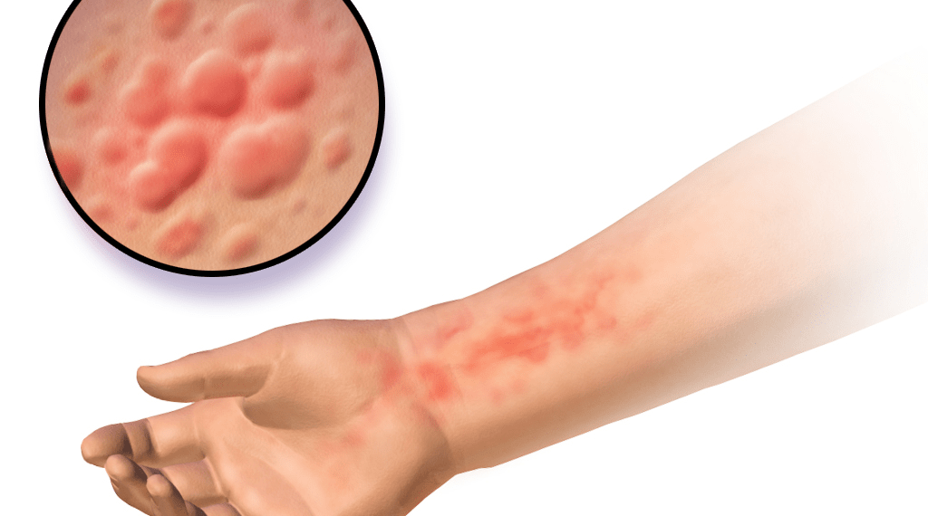 Aquagenic Urticaria Allergykb